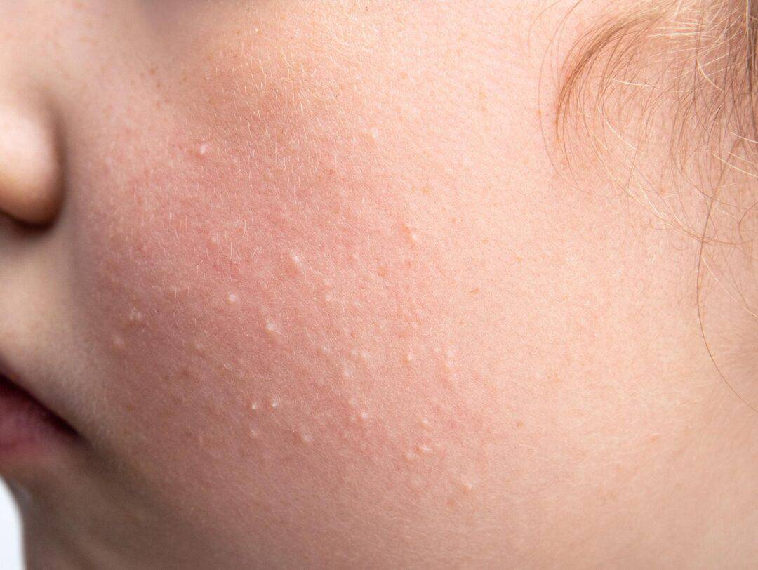 Skin Cysts Removal In Reading | Forbury Clinic