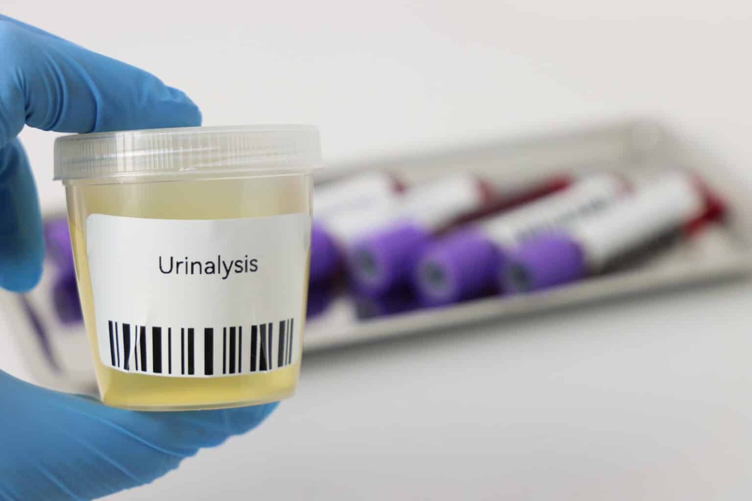 Comprehensive Urinalysis Testing In Reading | Forbury Clinic