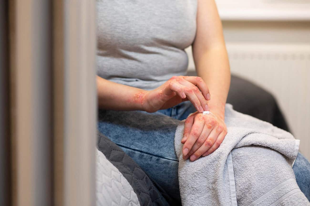 Eczema Treatment: Causes And Flare-Ups